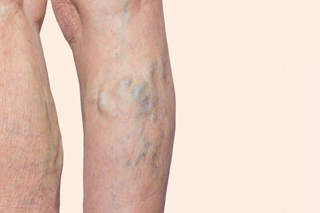 How Can I Find a Good Spider Vein Center in Houston? - Vein Clinics Texas